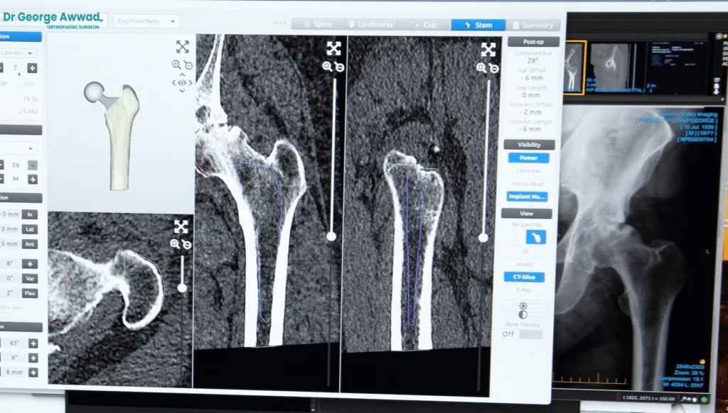 Total Hip Replacement (Arthroplasty) – Dr George Awwad